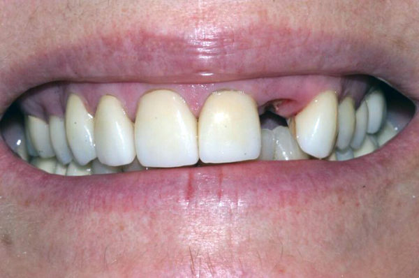 SINGLE IMPLANT CROWN – Team Root